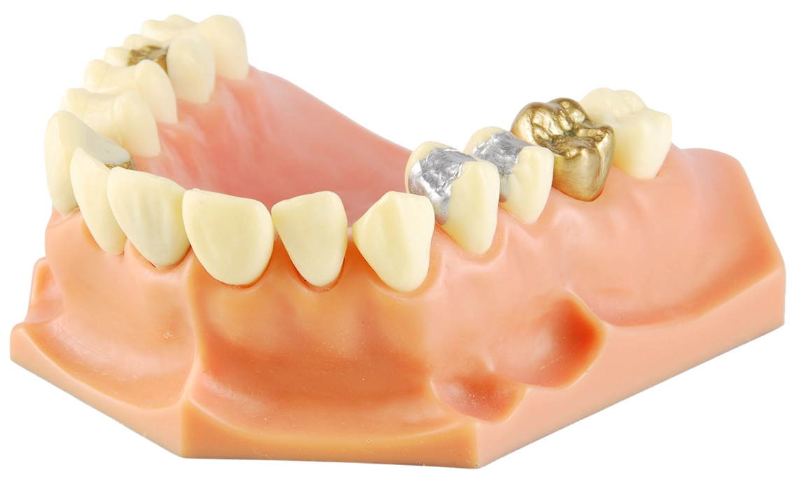 Are your amalgam fillings past their prime?